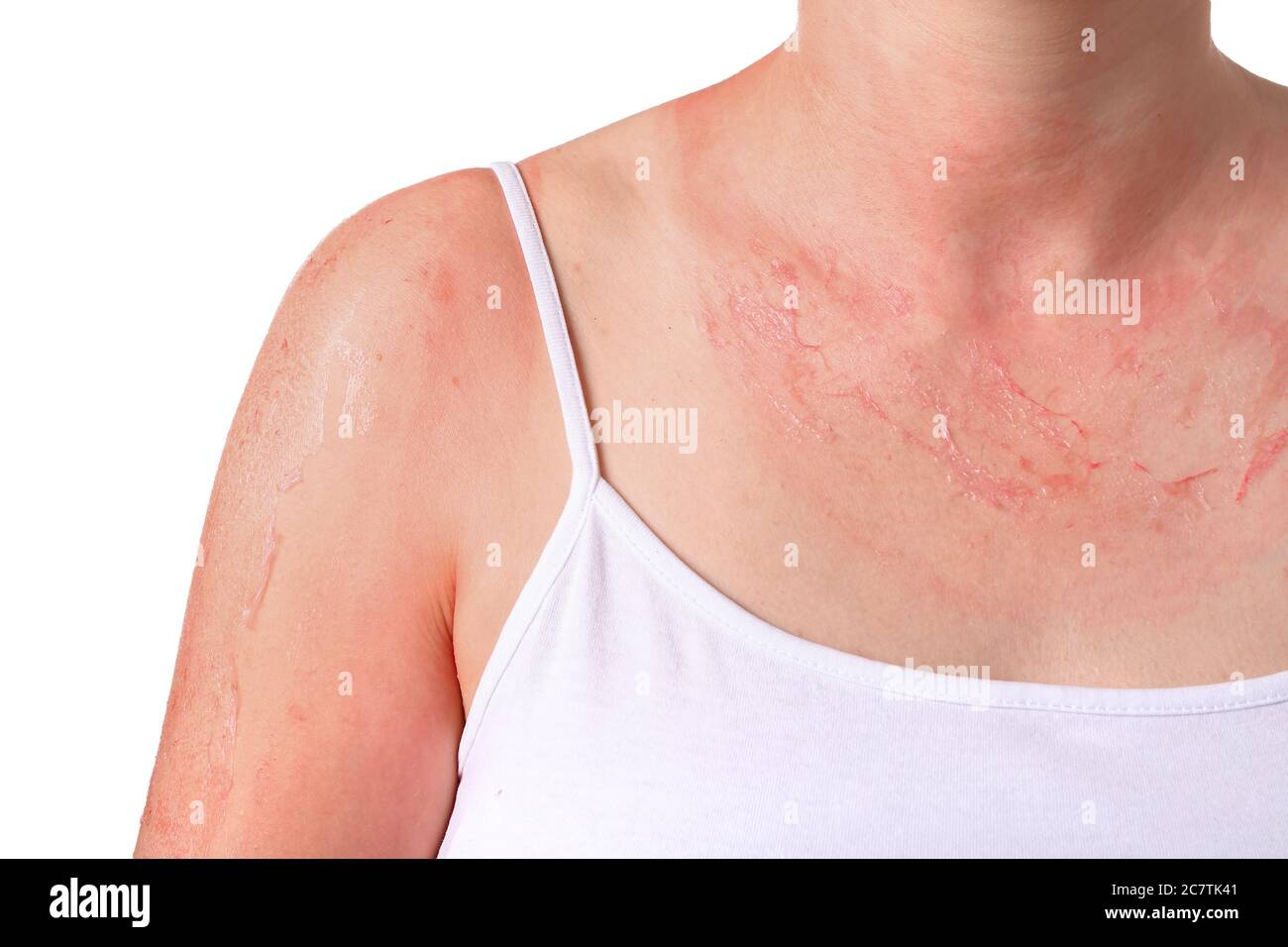 Dermatitis solar hi-res stock photography and images - Alamy