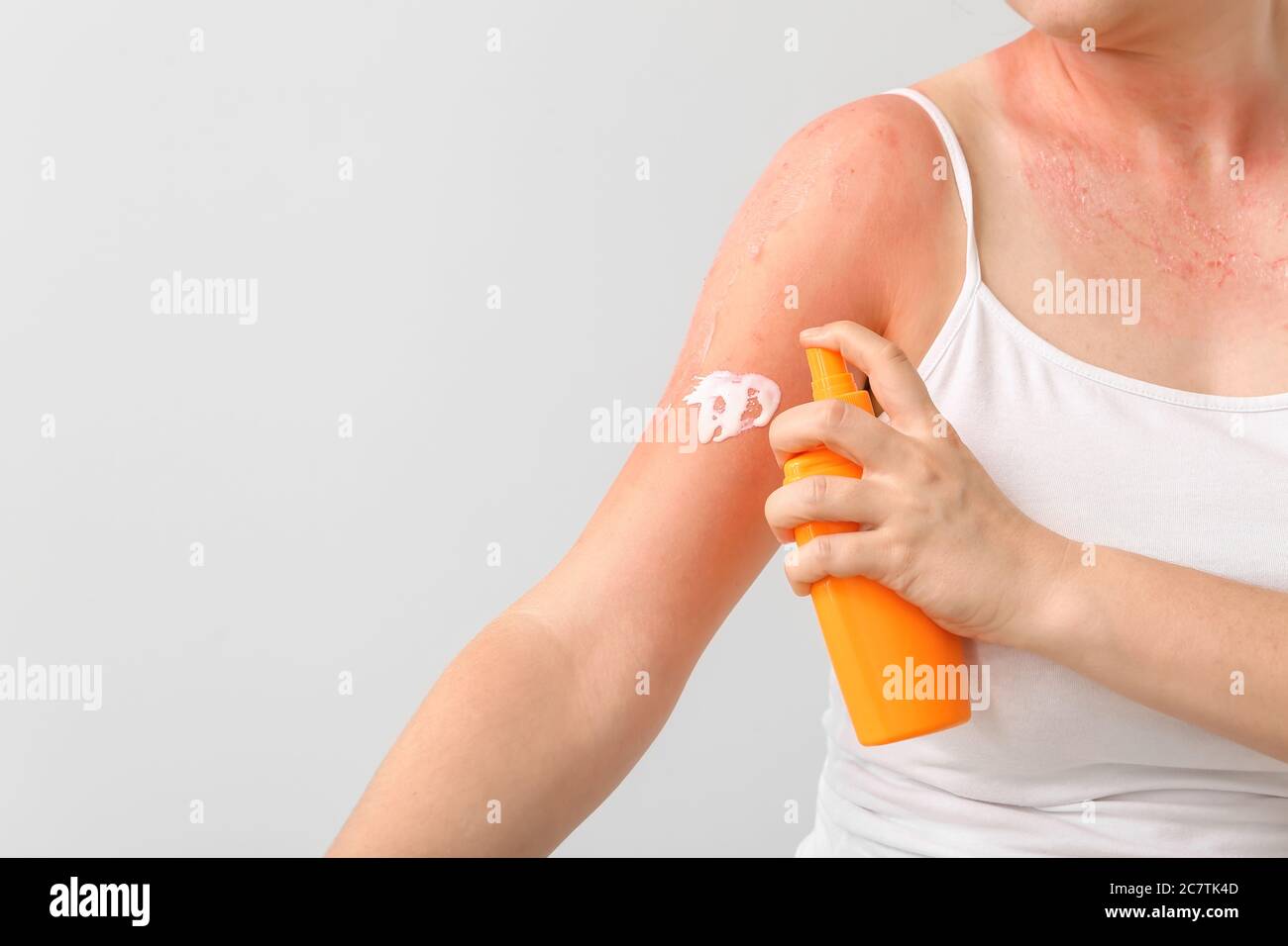 Dermatitis solar hi-res stock photography and images - Alamy
