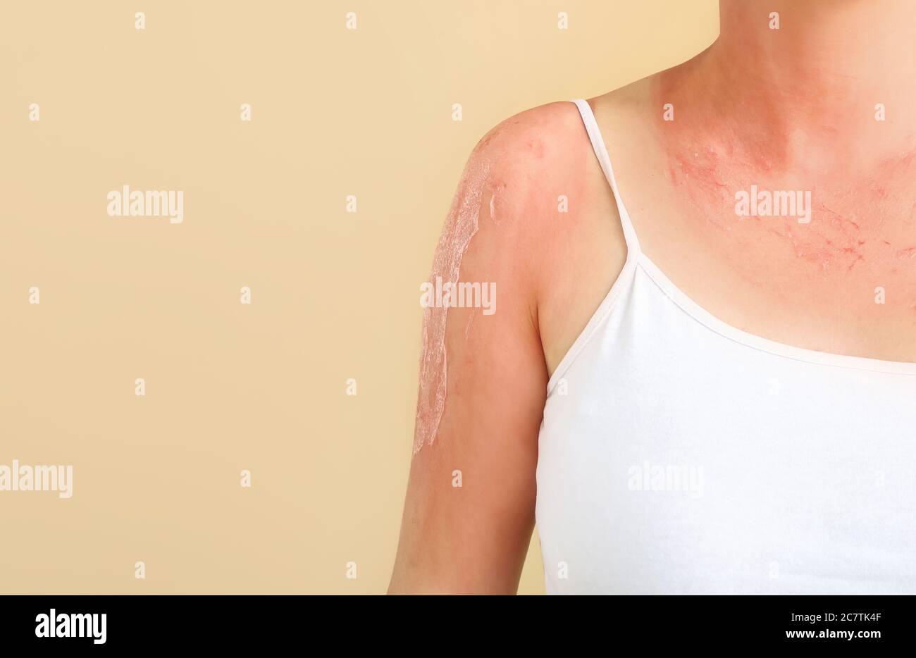 Woman with red sunburned skin against color background, closeup Stock ...
