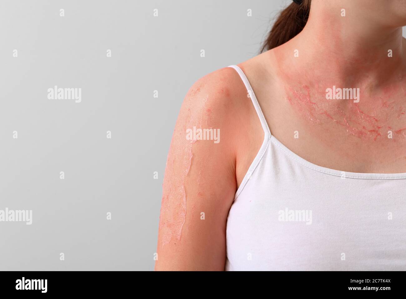 Woman with red sunburned skin against light background, closeup Stock ...