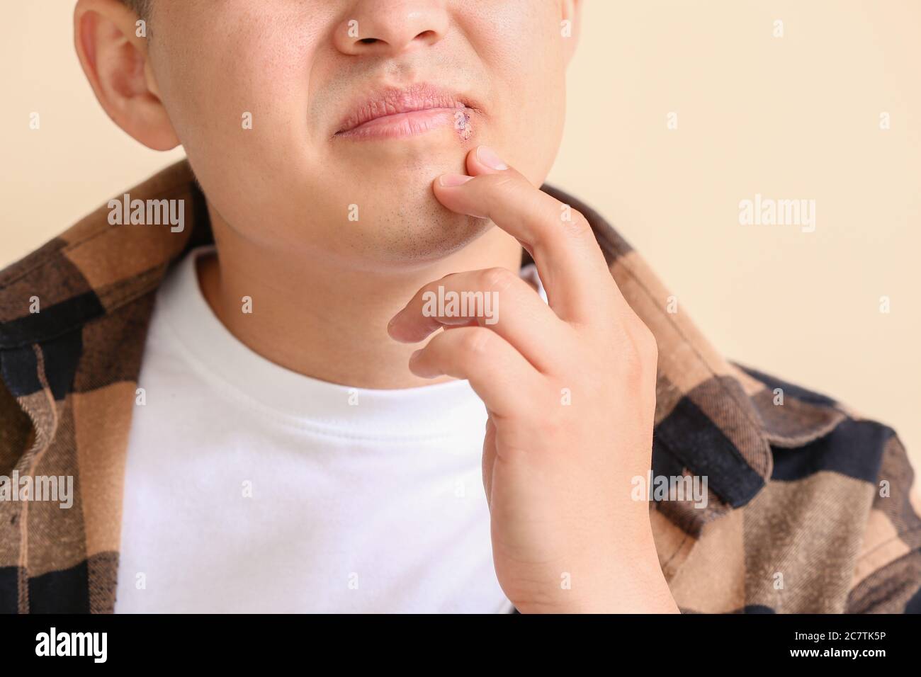 Cold sore on lip hi-res stock photography and images - Alamy