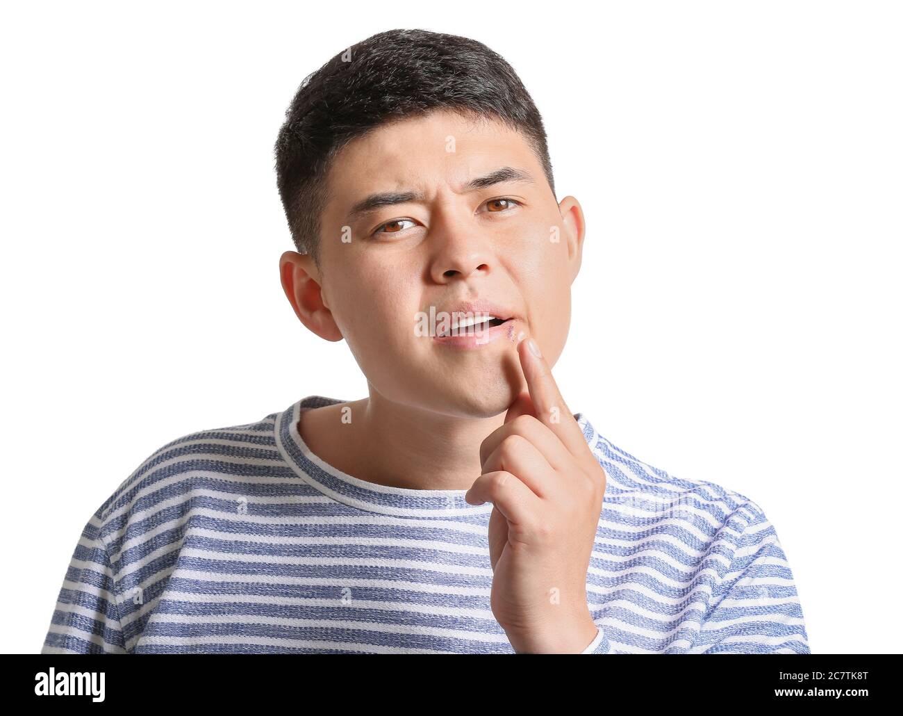 Asian man with cold sore applying ointment on his lips against white background Stock Photo - Alamy