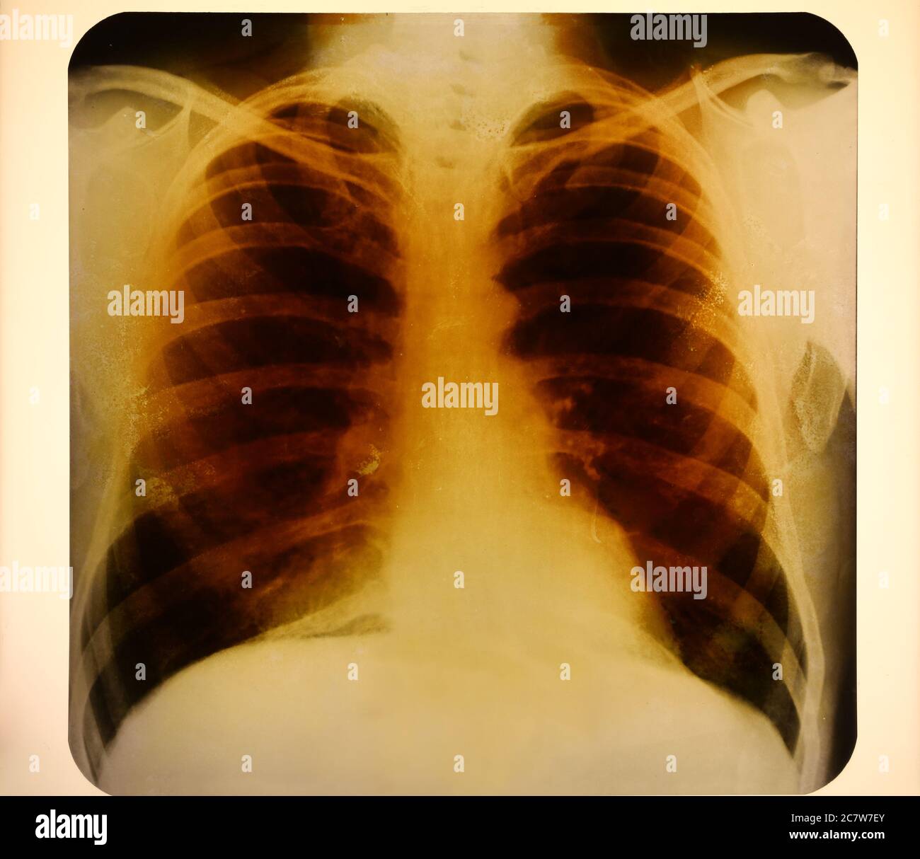 Ribcage xray hi-res stock photography and images - Alamy