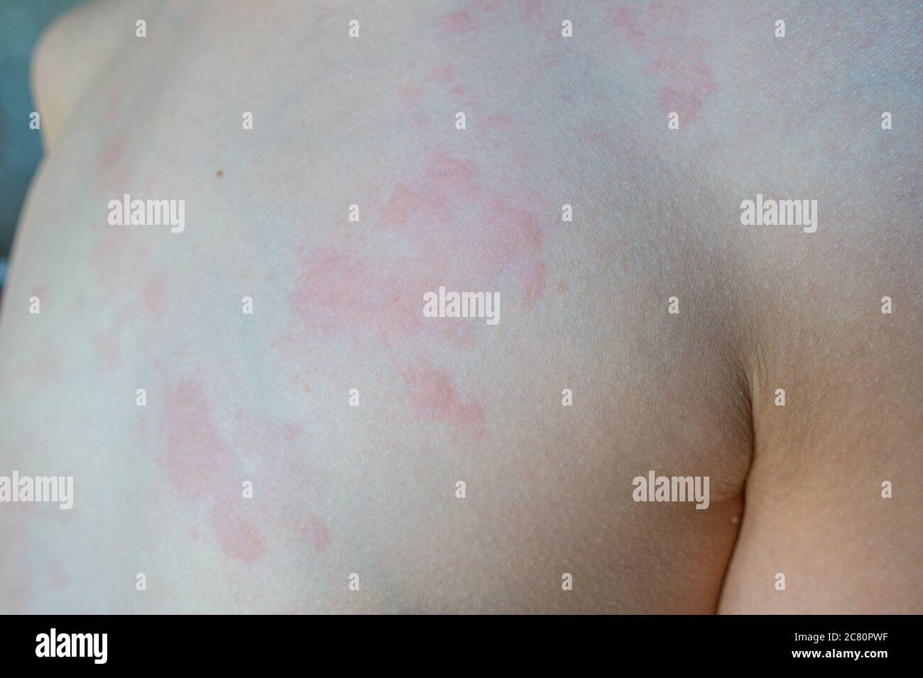 A child has broken out in hives, a raised angry red rash as a result of ...