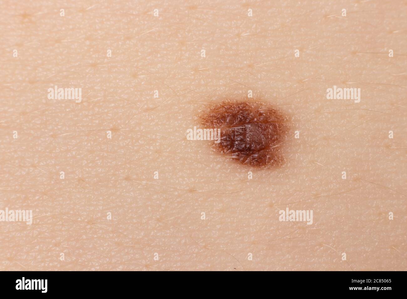 Different Types Of Birthmarks