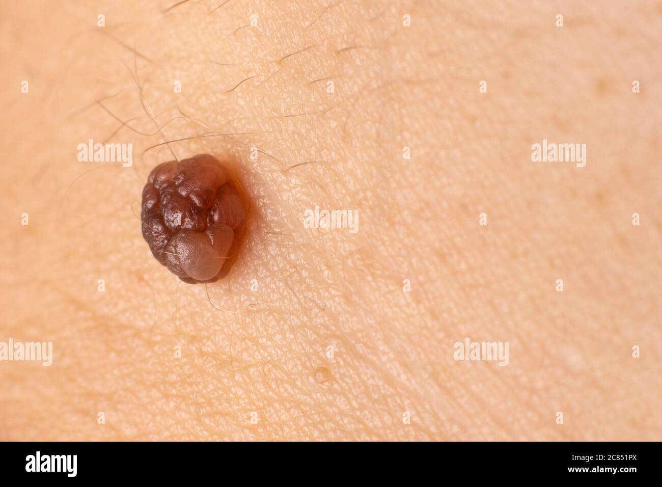 Benign mole hi-res stock photography and images - Alamy