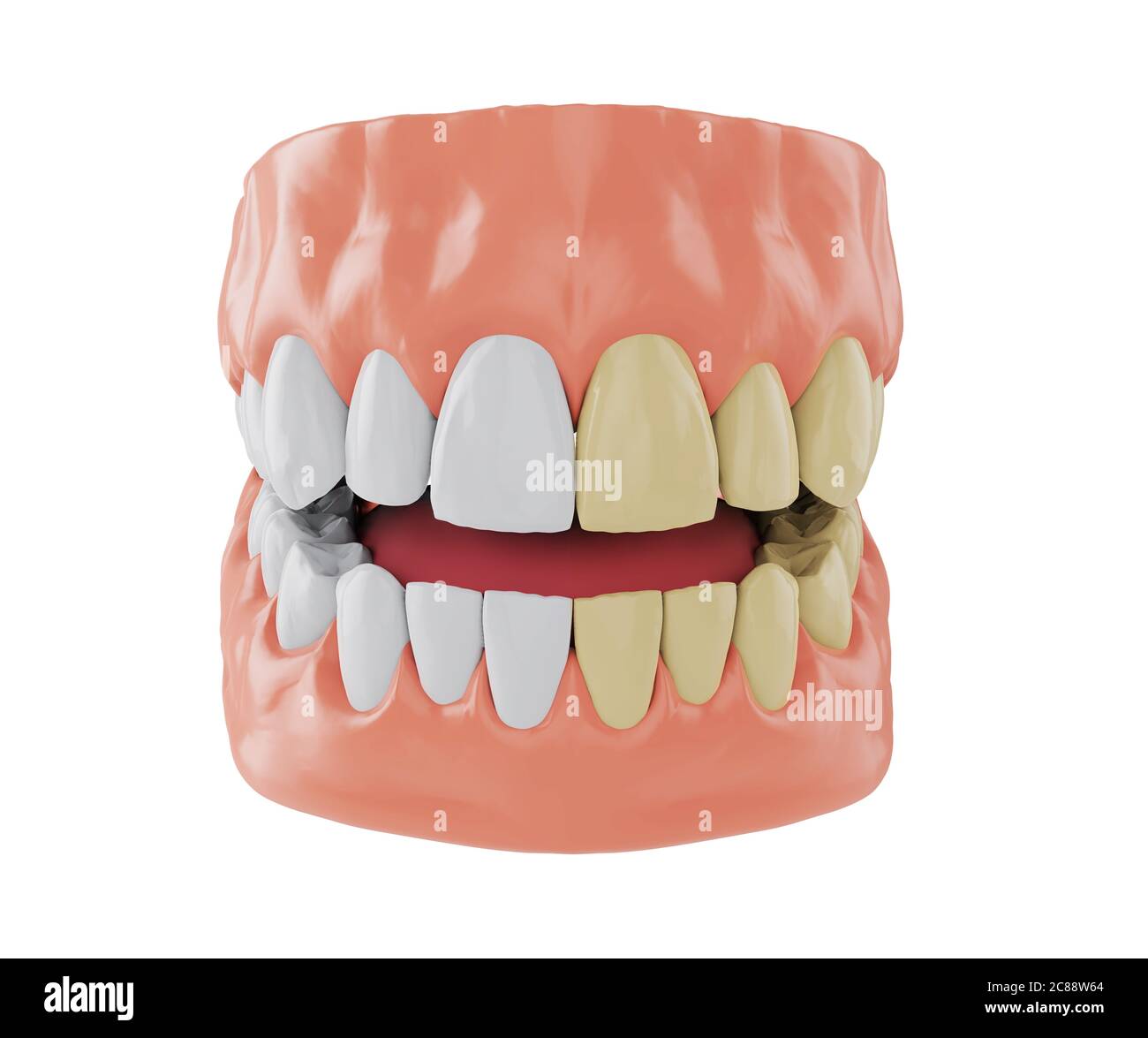 half jaw with yellow teeth and half jaw with whitened teeth, Before and ...