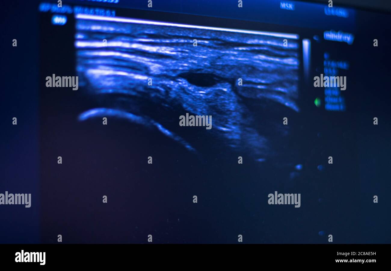 EPI Intratissue Percutaneous Electrolysis dry needling ultrasound ...