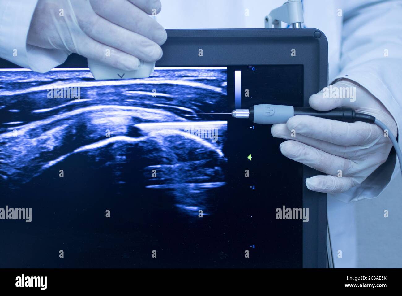 EPI Intratissue Percutaneous Electrolysis dry needling ultrasound ...