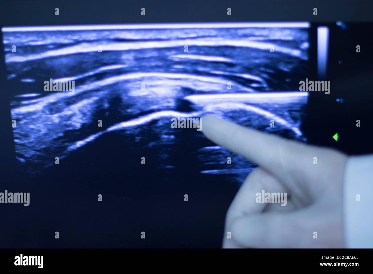 EPI Intratissue Percutaneous Electrolysis dry needling ultrasound ...