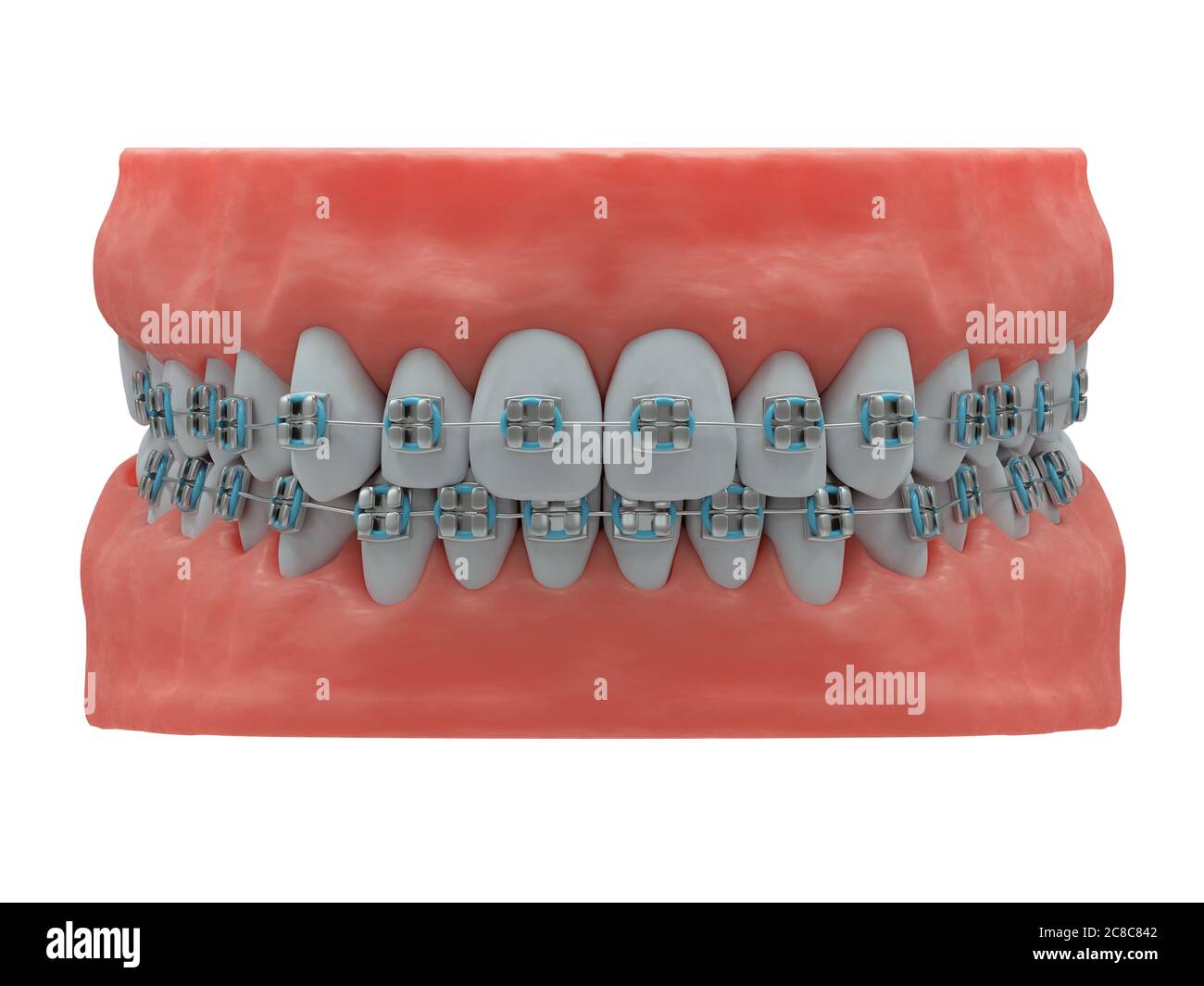 Realistic human jaws with healthy teeth and classic metal braces, front ...
