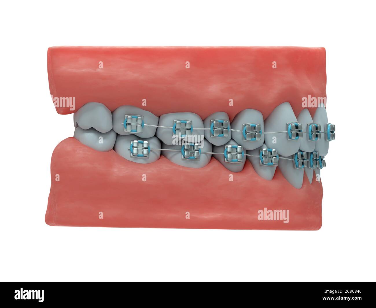 Realistic human jaws with healthy teeth and classic metal braces, side ...