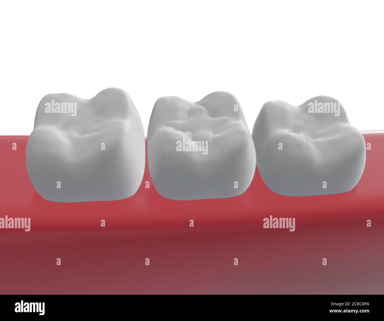 three molar teeth in the gum, polymer filling of a tooth in the middle ...