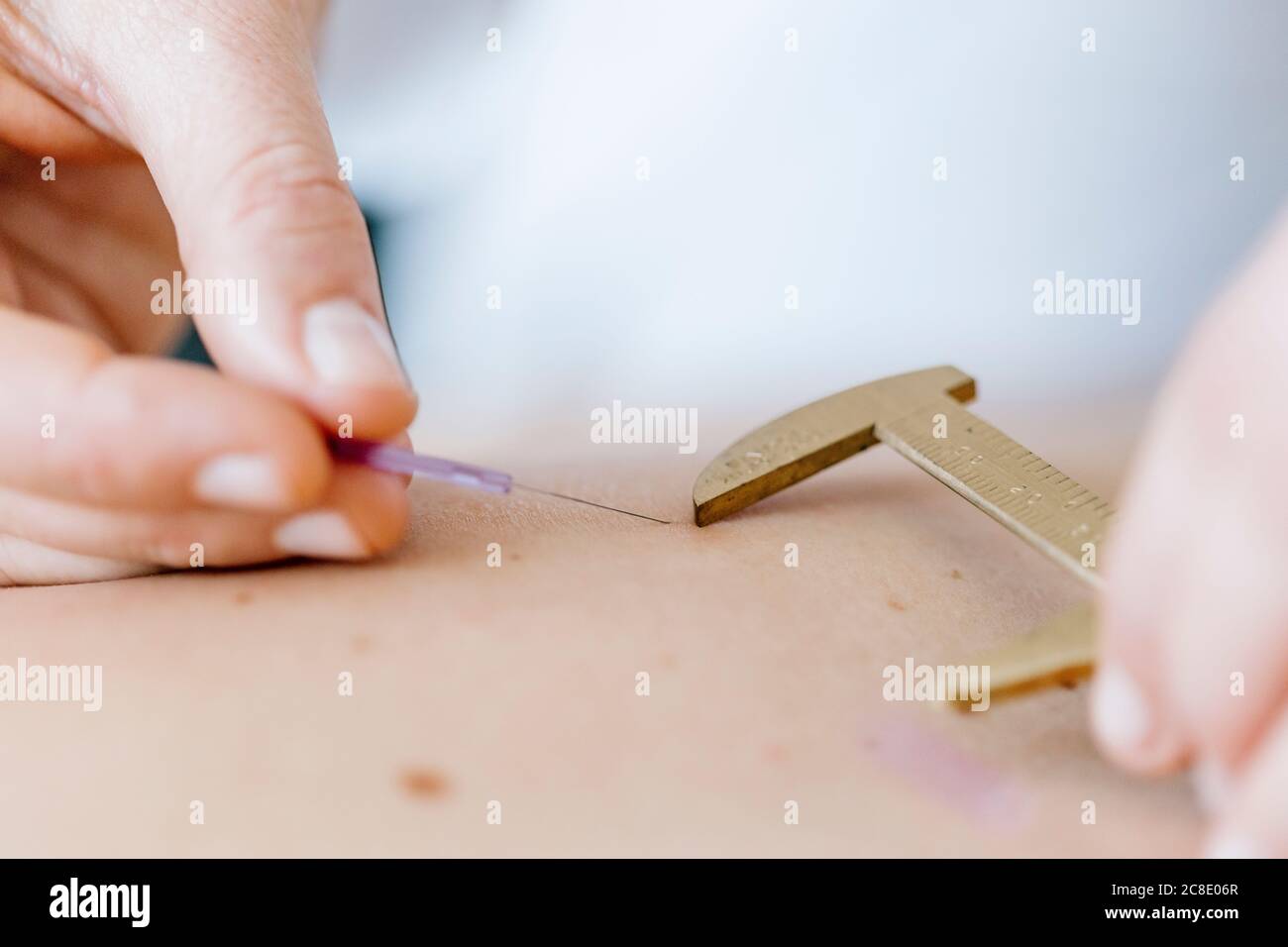Acupuncture, hand with calliper on back with acupuncture needle during ...