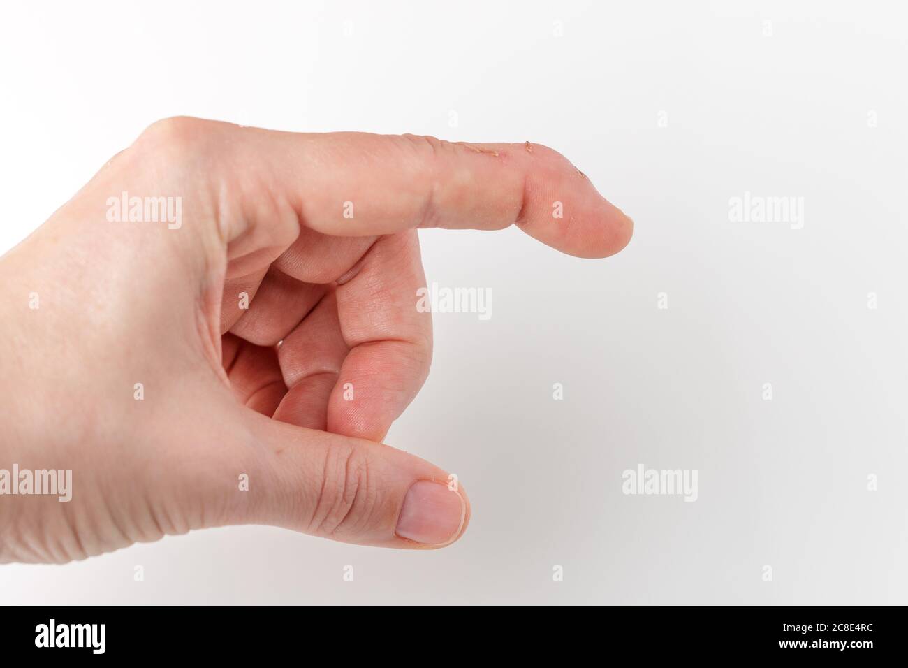 cut index finger with a extensor tendon injury, mallet finger wound ...