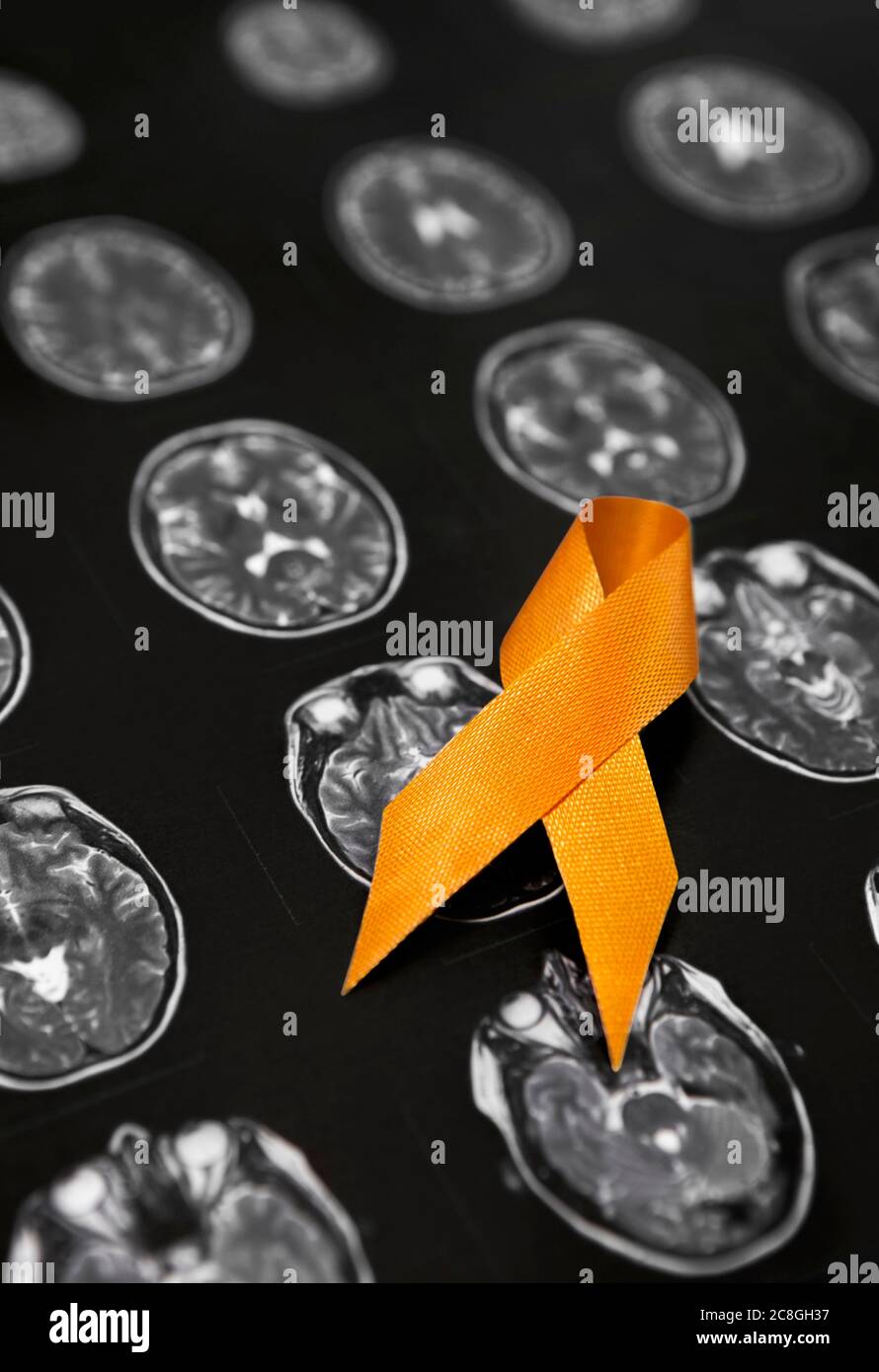 Multiple sclerosis mri hi-res stock photography and images - Alamy