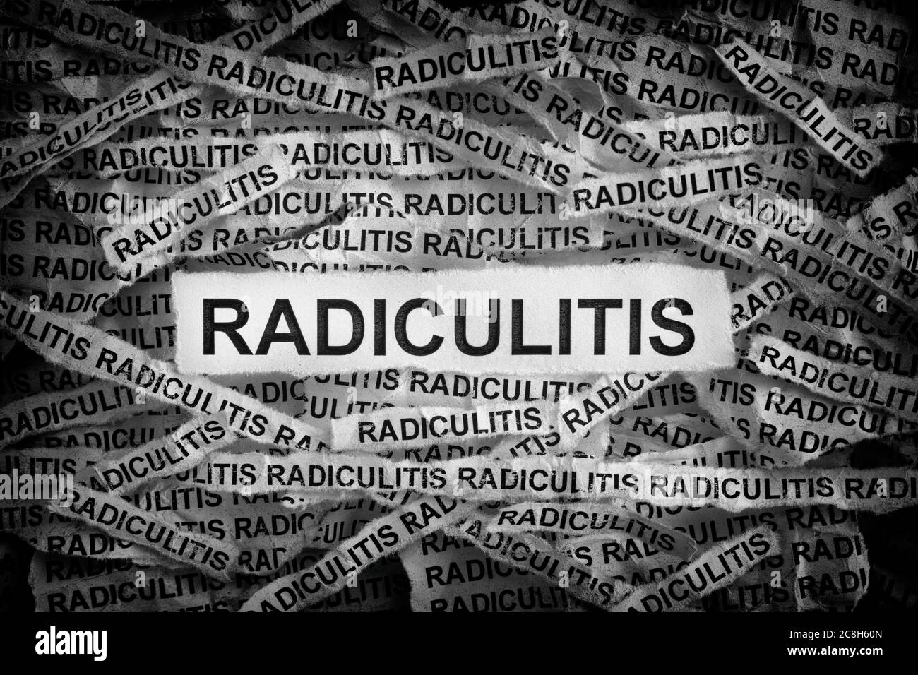 Radiculitis. Torn pieces of paper with the word Radiculitis. Concept ...