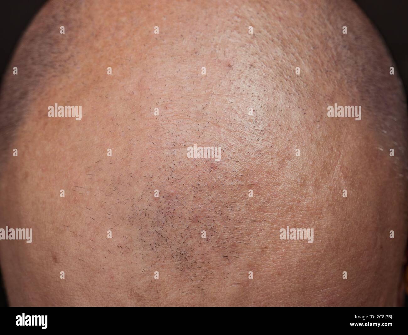 Human hair loss concept. Close up detail with a human head bald with ...