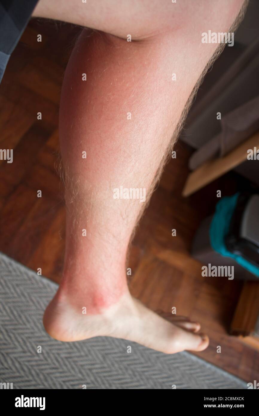 Sunburned feet hi-res stock photography and images - Alamy