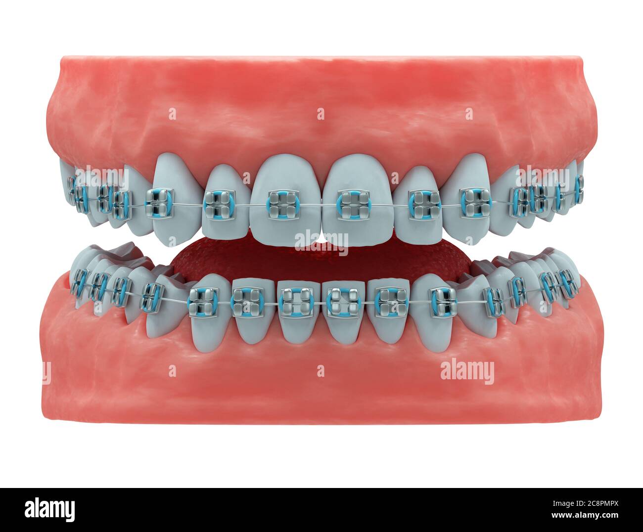 Metal Bracket Braces