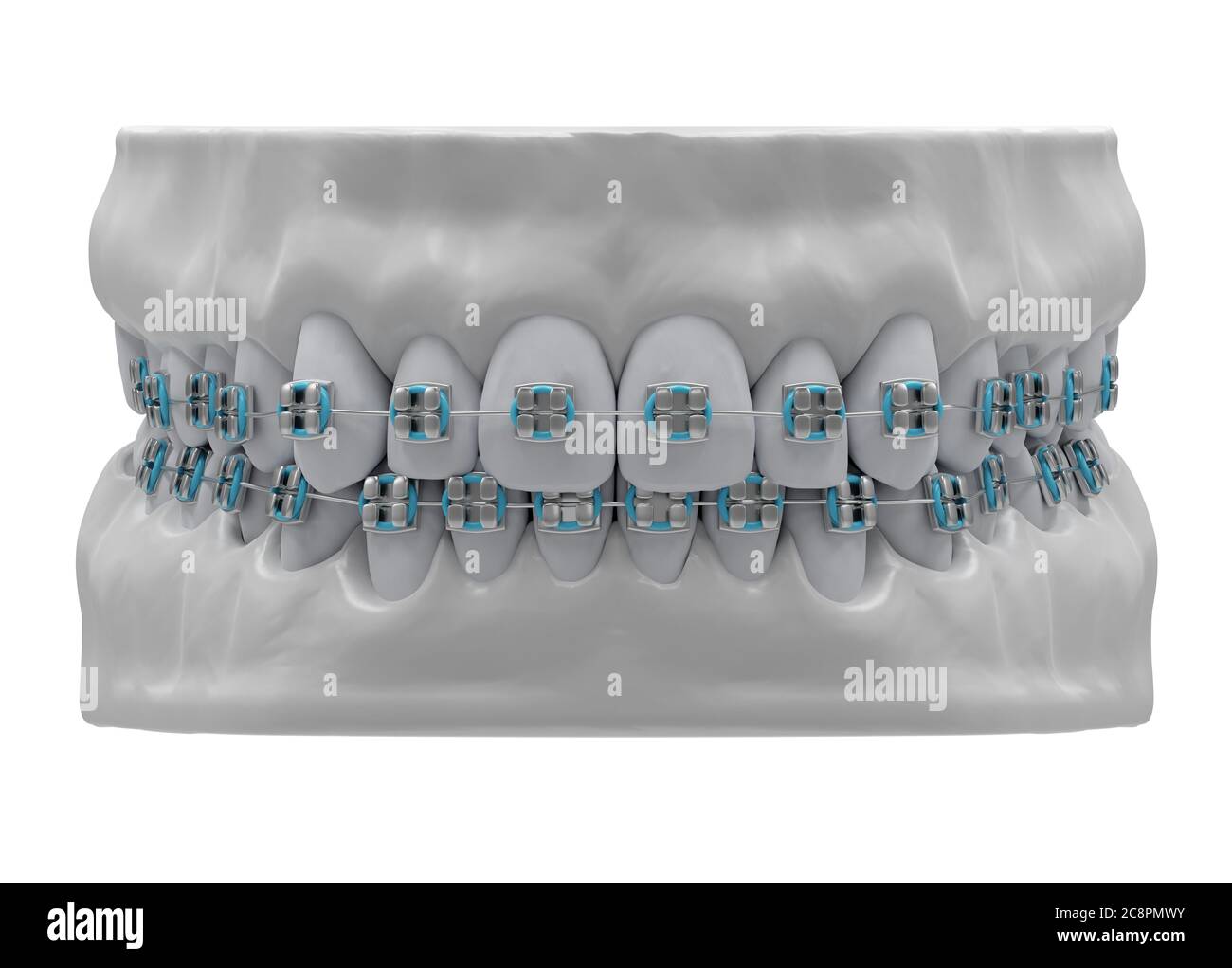 Human jaws with healthy teeth and classic metal braces, front view ...