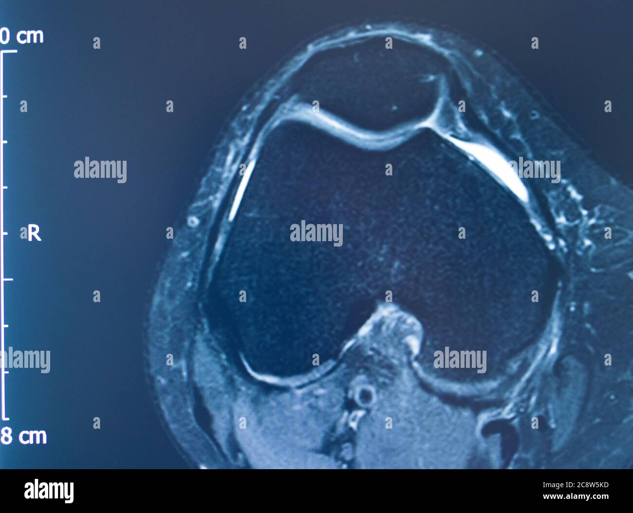 Knee sports injury mri mcl grade 2 tear magnetic resonance imaging ...