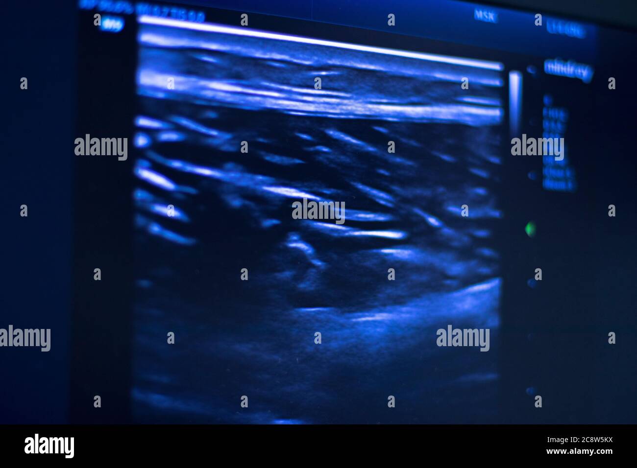 EPI Intratissue Percutaneous Electrolysis dry needling ultrasound ecography scan physiotherapy ...