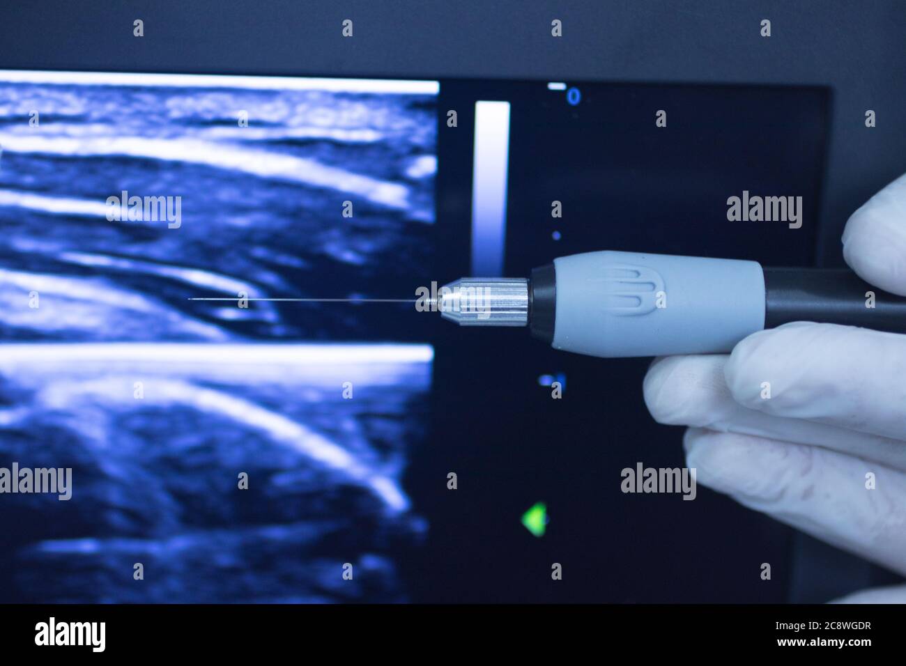 EPI Intratissue Percutaneous Electrolysis dry needling ultrasound ecography scan physiotherapy ...
