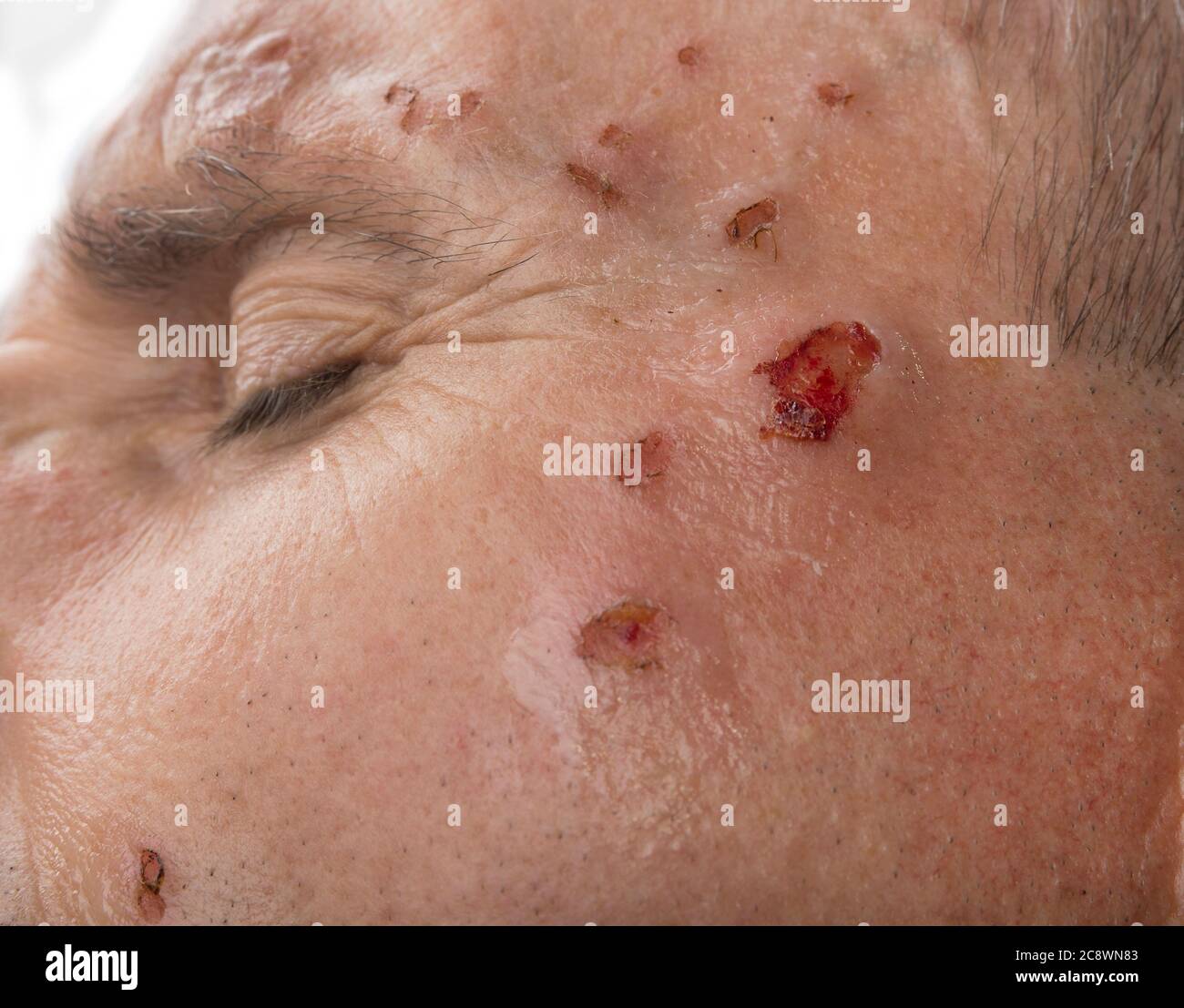 Face scab hi-res stock photography and images - Alamy