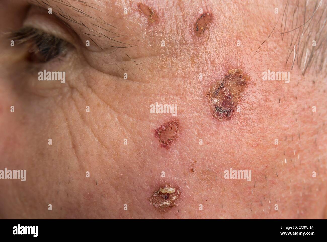 Facial wound hi-res stock photography and images - Alamy