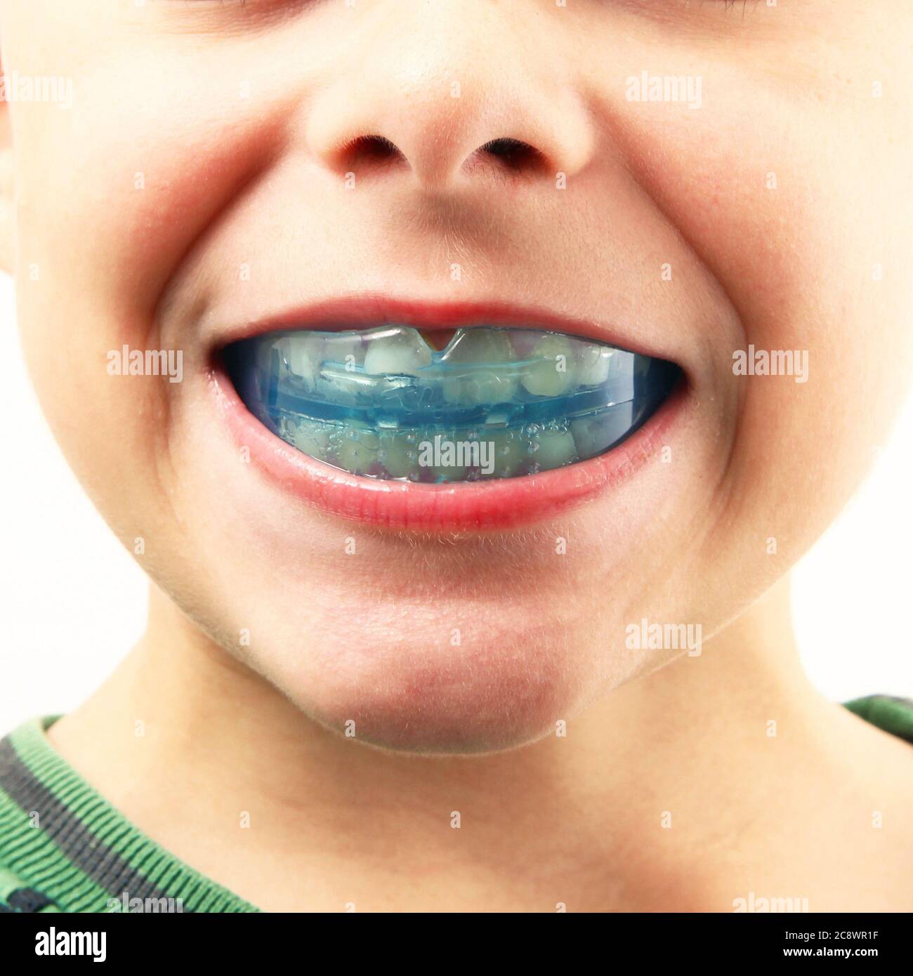 Child with silicone orthodontic device Stock Photo - Alamy