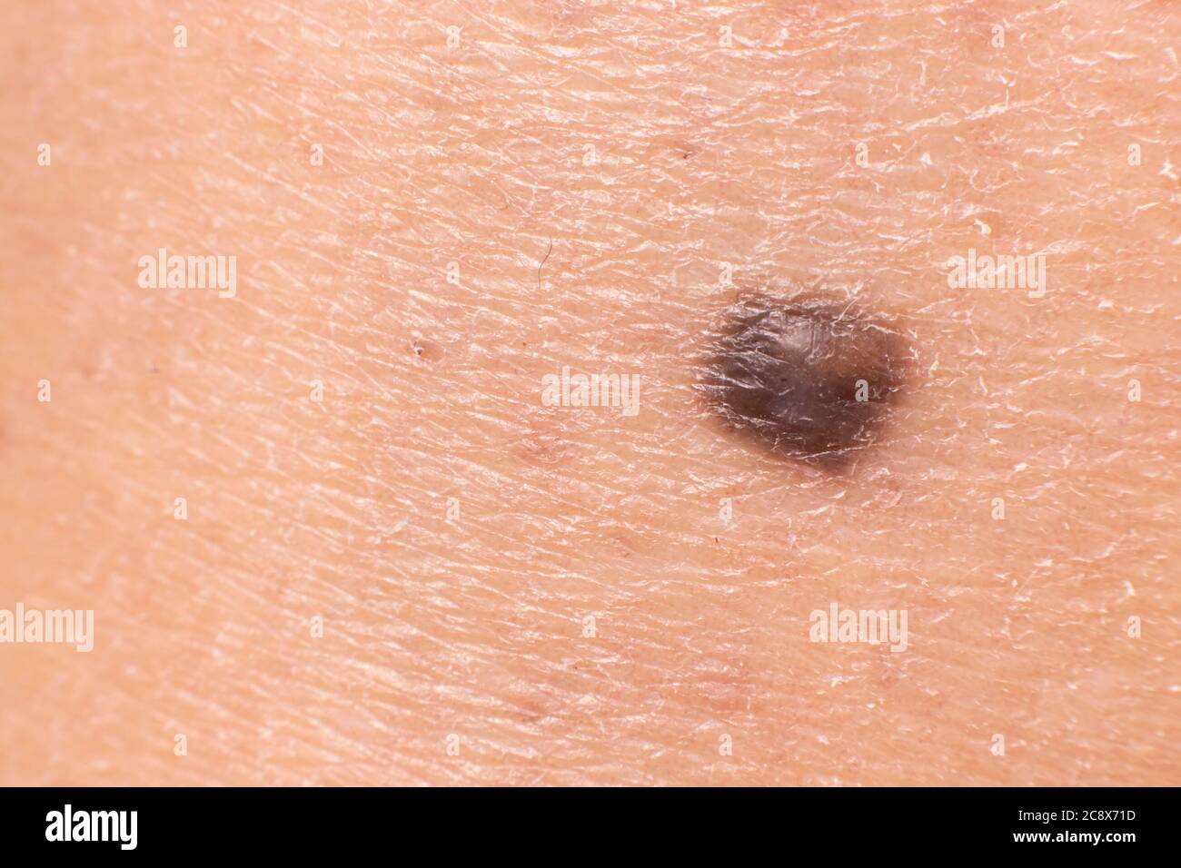Skin cancer mole on dark skin hi-res stock photography and images - Alamy