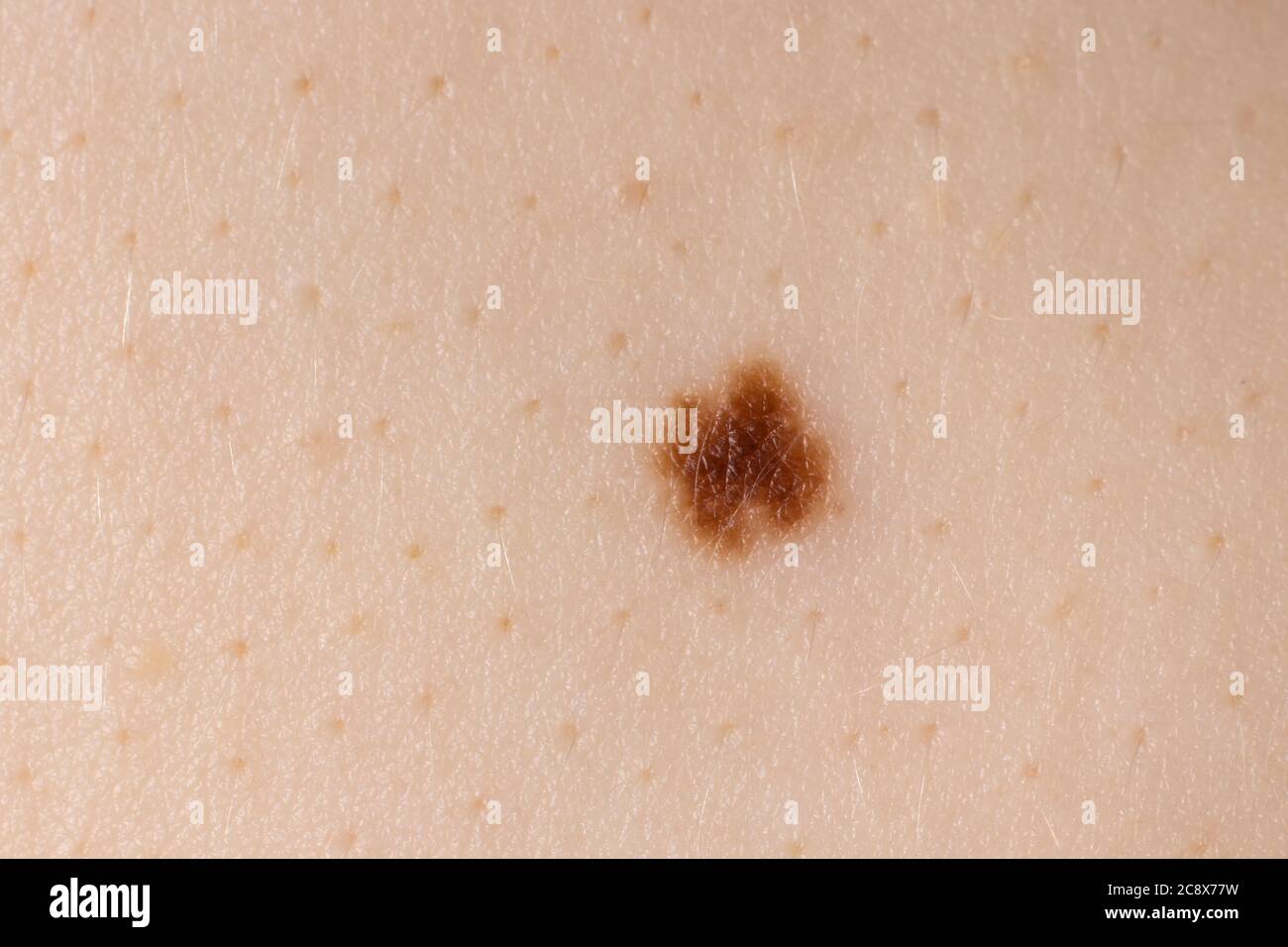 Epidermal nevus hi-res stock photography and images - Alamy