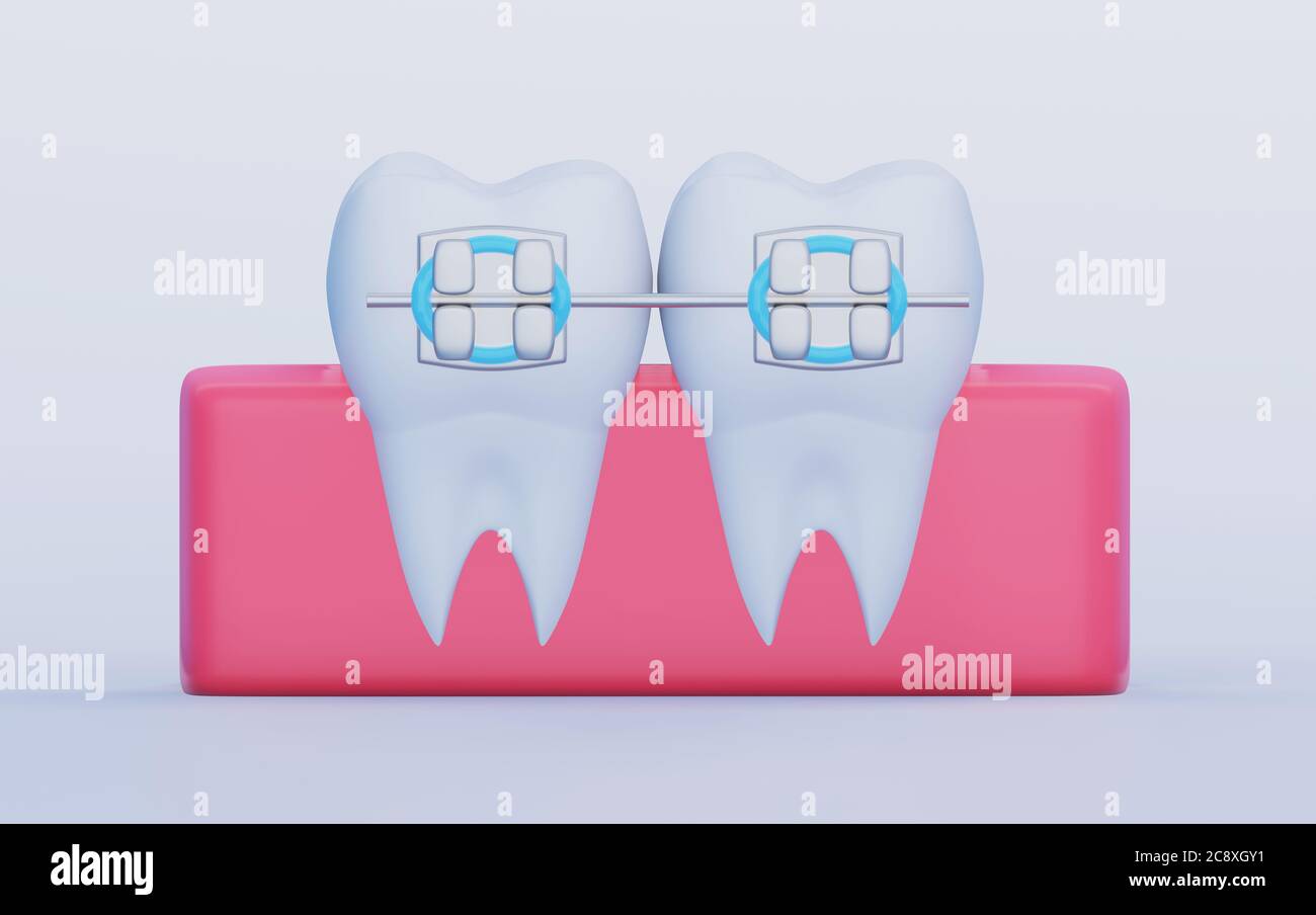 Two Teeth with Metal Braces, molars in the gum, front view. Care ...