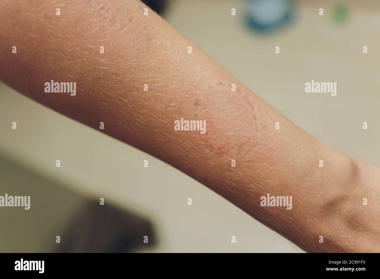 Toddler's bite marks on mothers arm - aggressive toddlers behavior ...