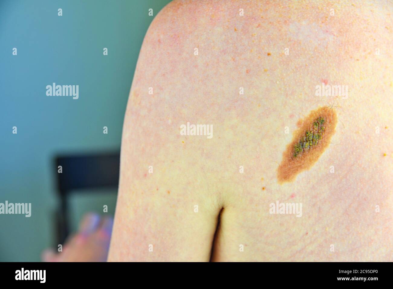 Epidermal nevus hi-res stock photography and images - Alamy