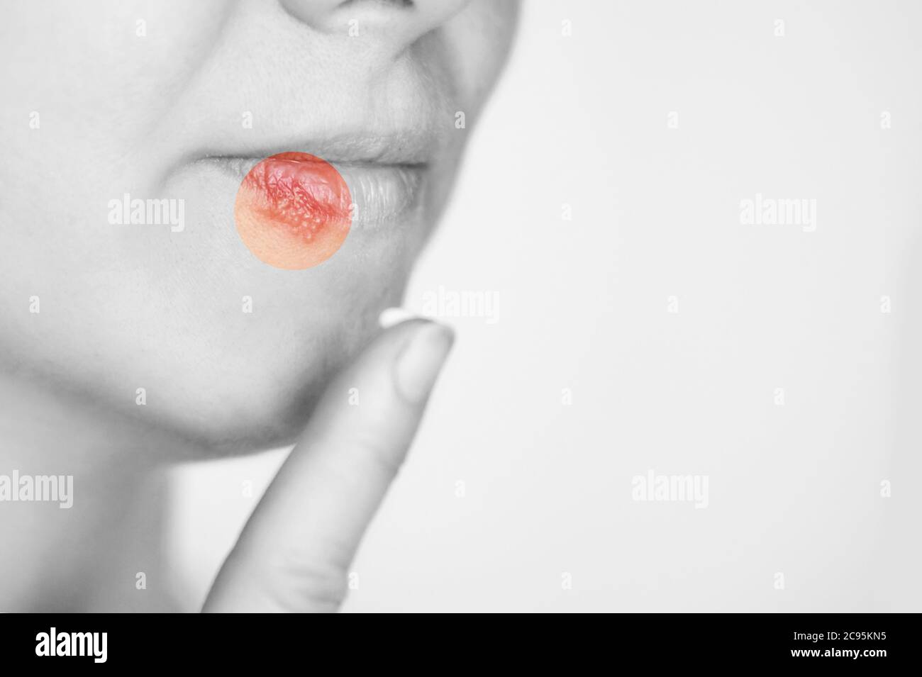 Girl with herpes. Sick symptom. Lips cold Stock Photo - Alamy