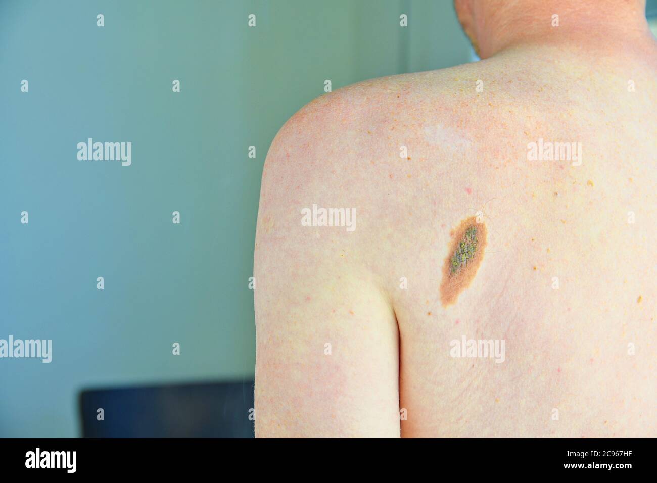 Pigmented nevus. Big flat benign brown birthmark on man back. Close up ...
