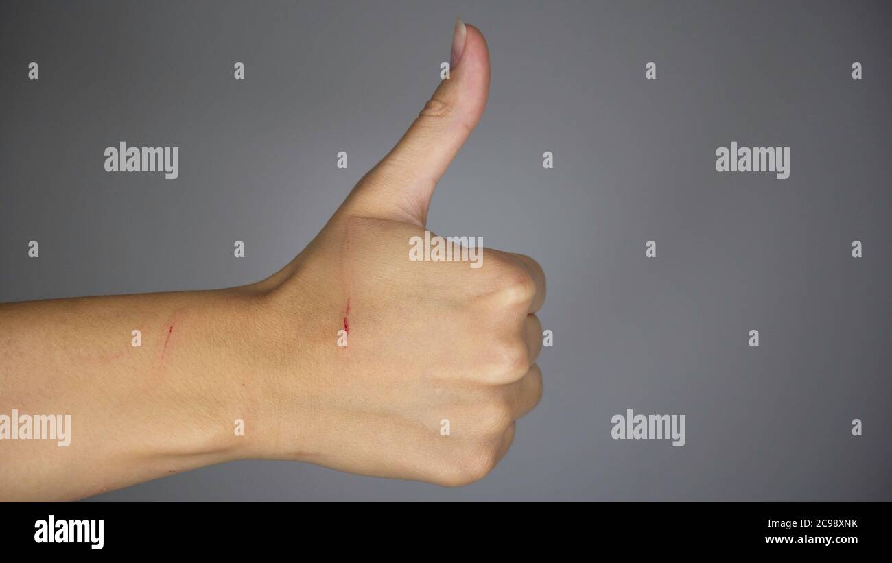 Cat scratch disease hi-res stock photography and images - Alamy