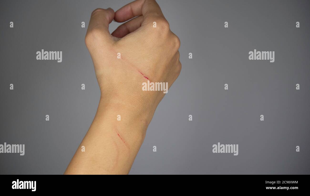 Cat scratch disease hi-res stock photography and images - Alamy