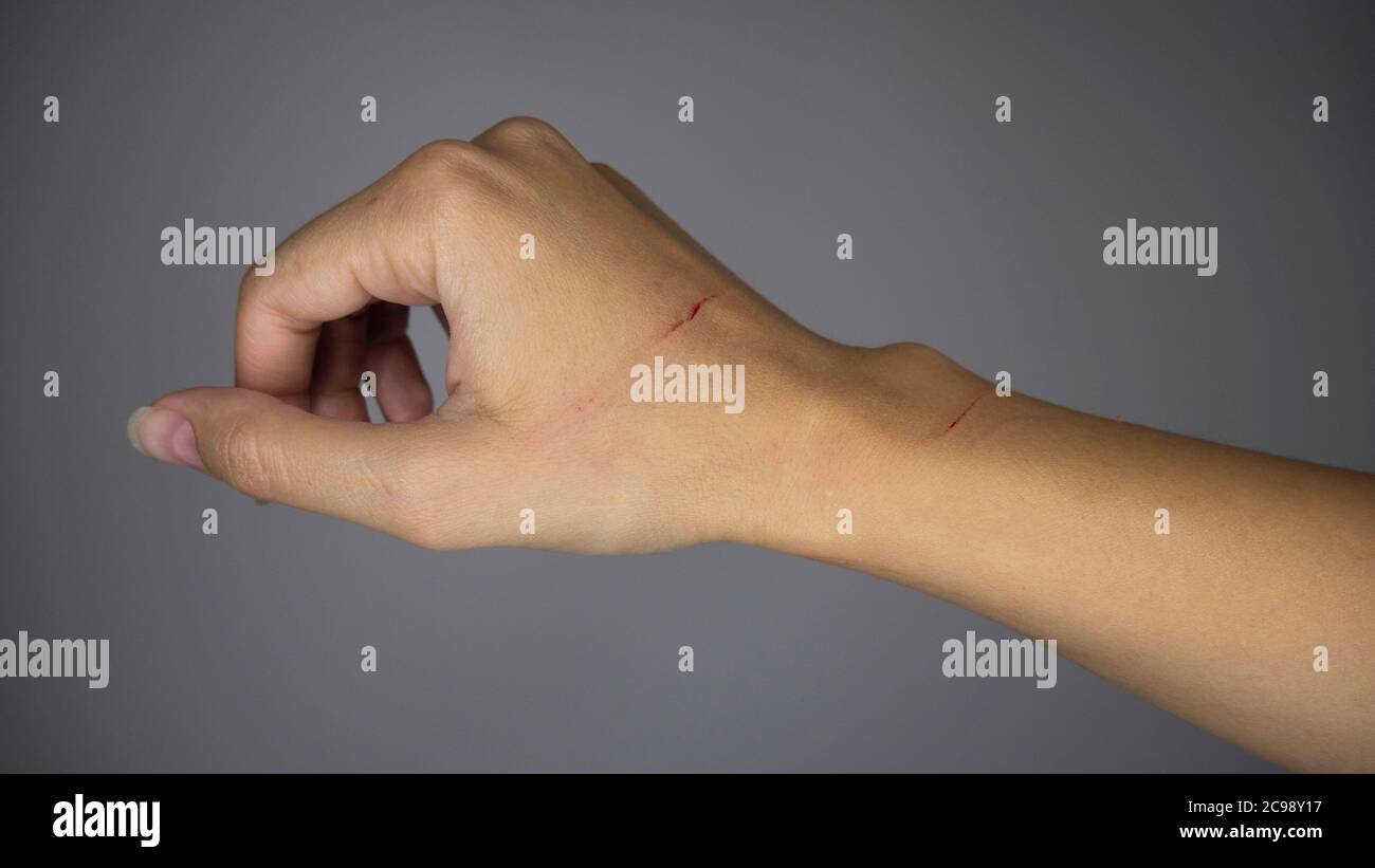 Cat Scratch Disease. A scratched female hand from a cat Stock Photo - Alamy