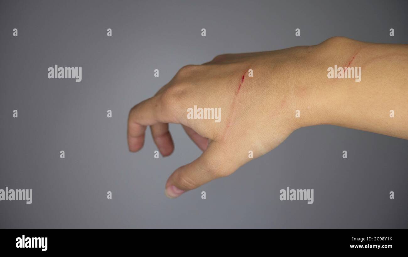Cat scratch disease hi-res stock photography and images - Alamy