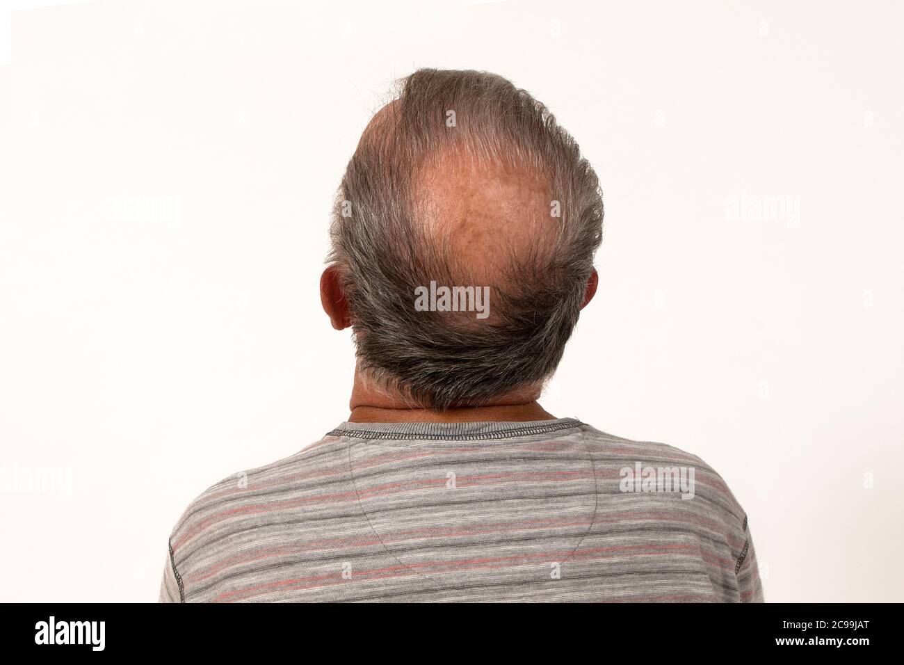 genetic male balding Stock Photo - Alamy