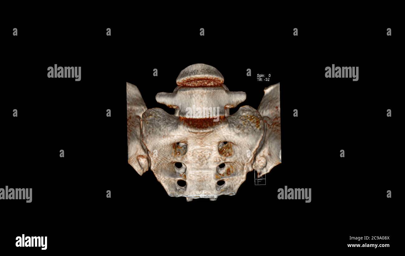 Computed Tomography Volume Rendering Examination Of The Sacroiliac Joints Ct Vr Sacroiliac