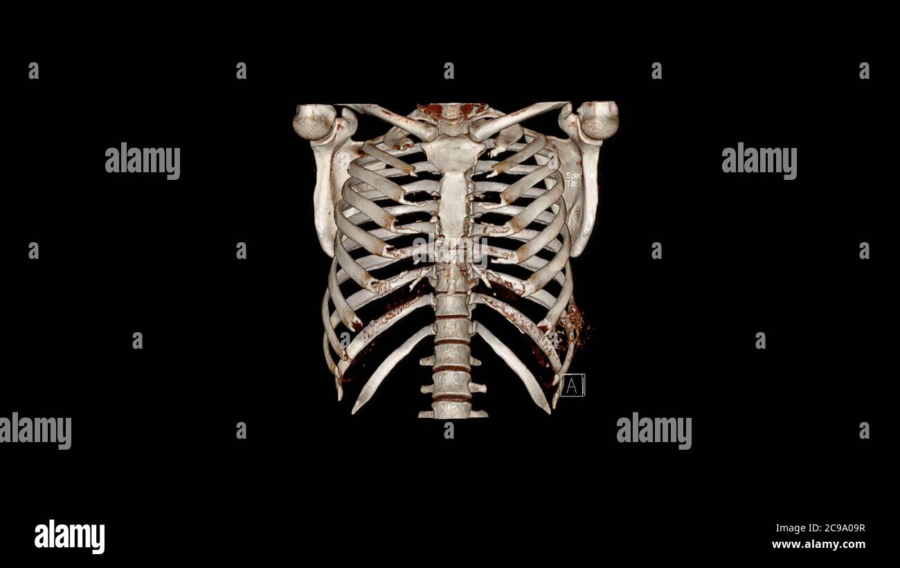 Computed Tomography Volume Rendering examination of the thoracic cage ...