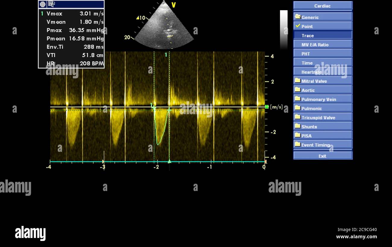 Image of the heart in gray-scale mode during transesophageal ultrasound ...