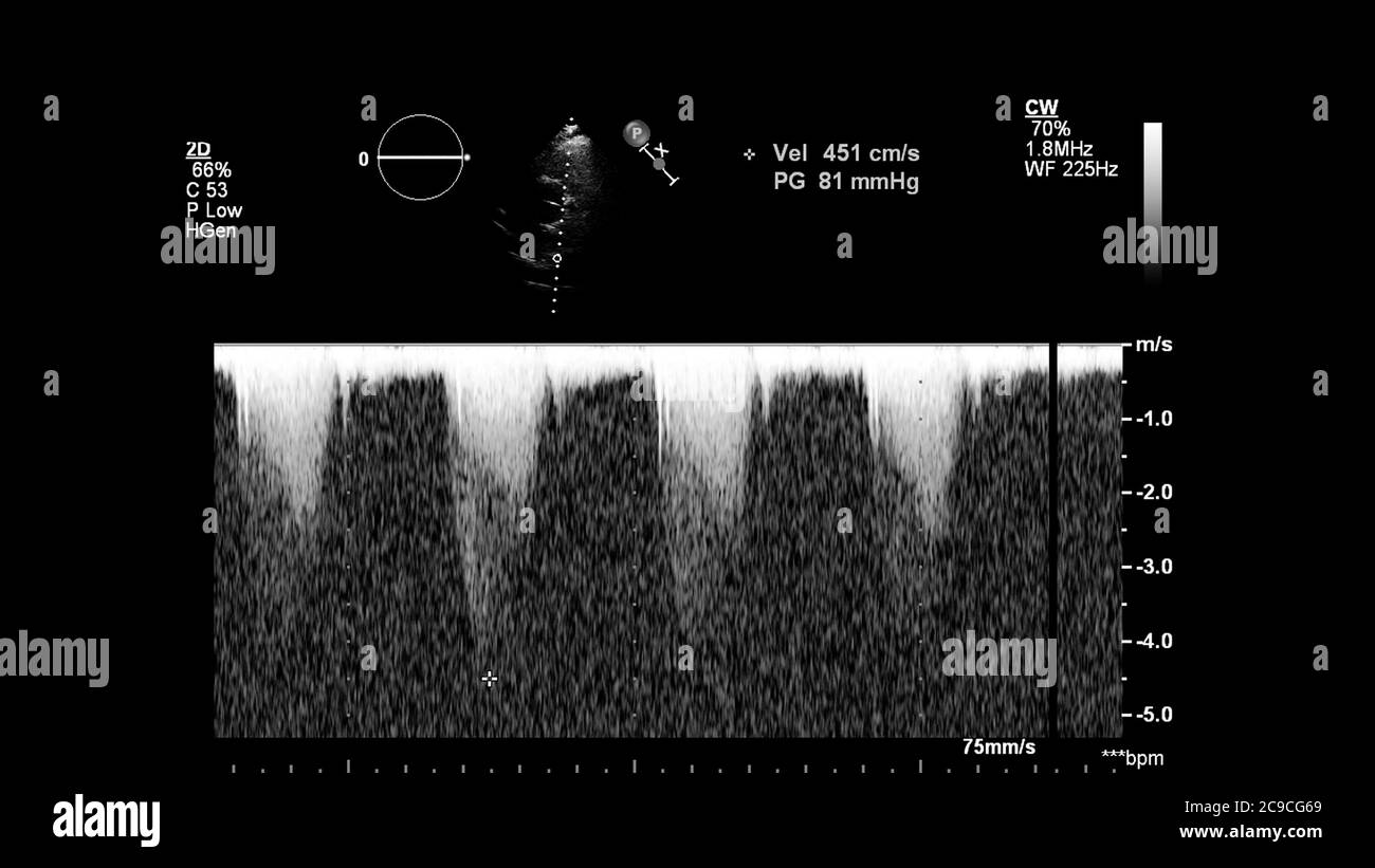 Image of the heart in gray-scale mode during transesophageal ultrasound ...