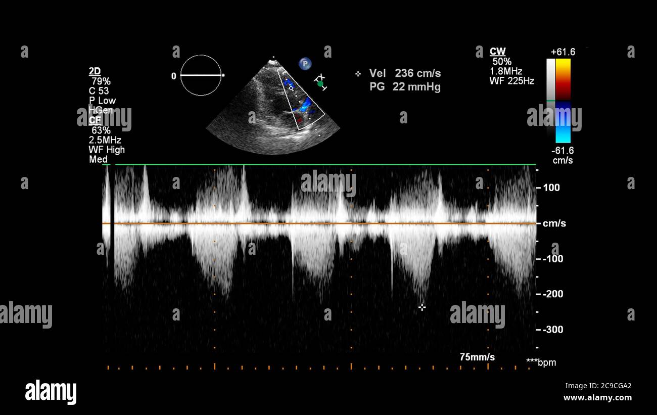 Image of the heart during transesophageal ultrasound with Doppler mode ...