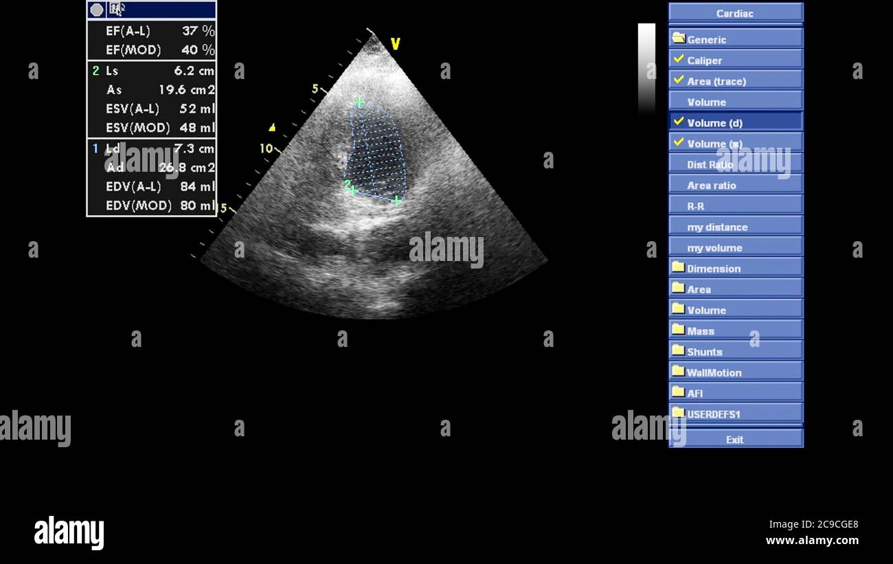 Image of the heart in gray-scale mode during transesophageal ultrasound ...
