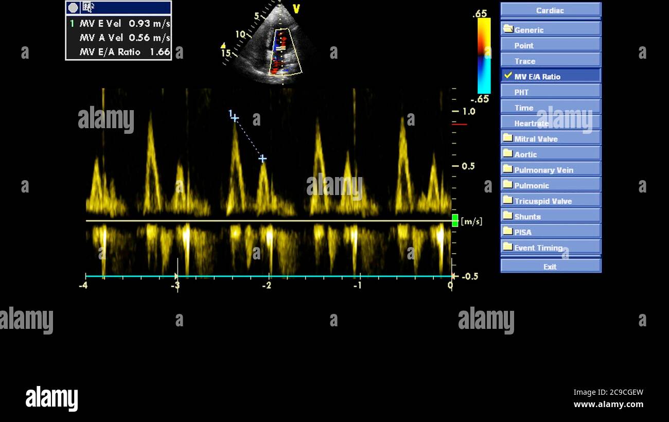 Image of the heart during transesophageal ultrasound with Doppler mode ...